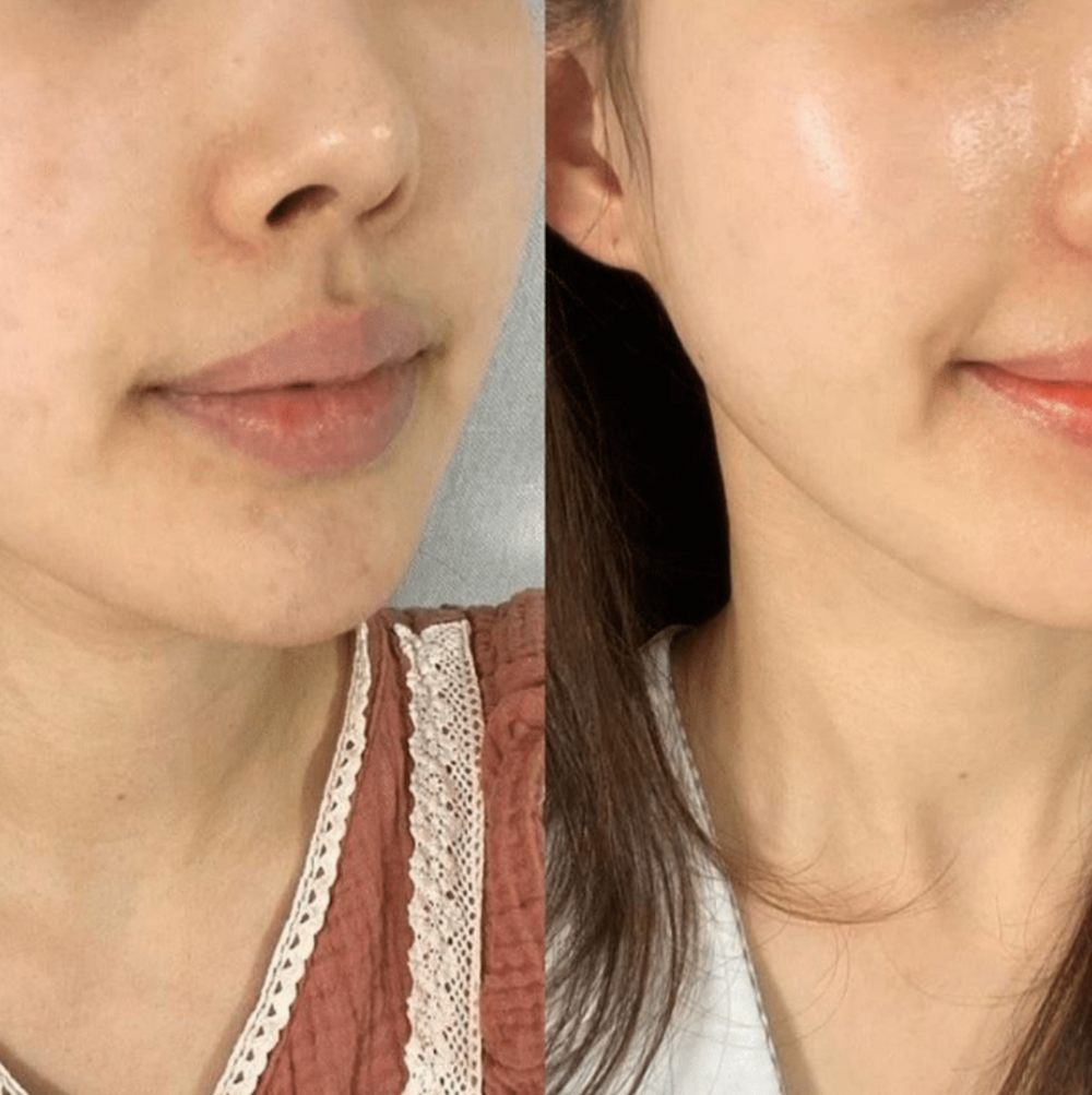 Exomide Skin Rejuvenation